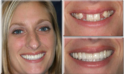 Smile South Florida Dental Extreme Makeovers Do Not Require Extreme ...