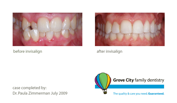 Columbus, Ohio Dentist Office Offers Free Professional Teeth Whitening ...