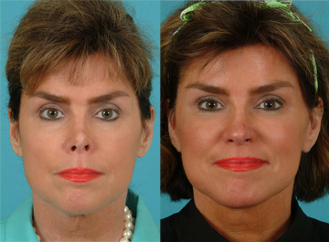 Dr. Dean Toriumi Specializes in Correcting Short Nose Deformity Using ...