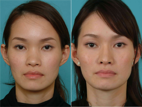 Highly Regarded Surgeon Dr. Dean Toriumi Develops New Technique for ...