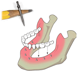 Top 10 Advantages of Mini (Minimally Invasive) Dental Implants
