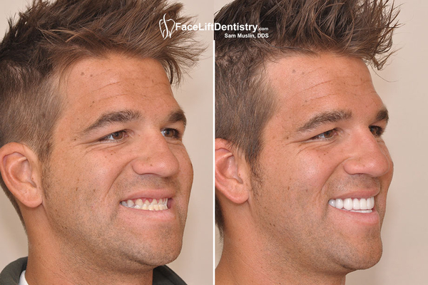 Face Lift Dentistry Expert Dr. Sam Muslin Reverses the Effects of Aging ...