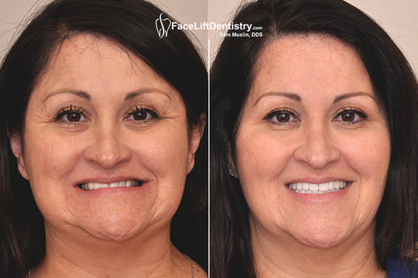 Face Lift Dentistry Expert Dr. Sam Muslin Reverses the Effects of Aging ...