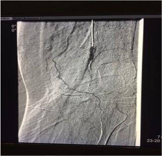 Novel Mechanical Thrombectomy Device Successfully Treats 100 Year Old ...