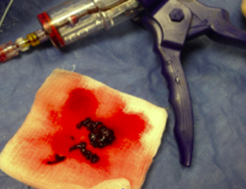 Novel Mechanical Thrombectomy Device Used in Live Case to Remove Clot ...