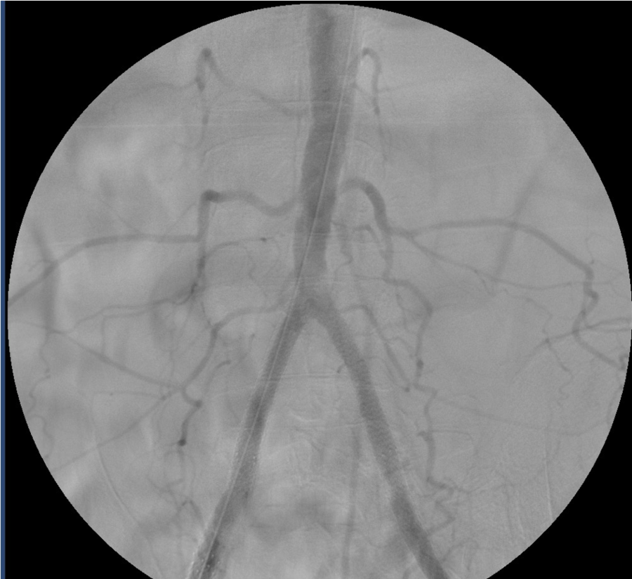 New Angiographic Injector Used to Image Peripheral Arteries