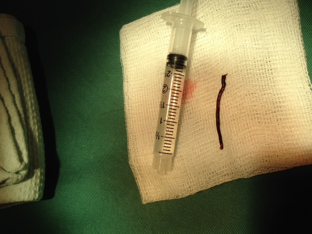 FDA Clears New Mechanical Thrombectomy Platform